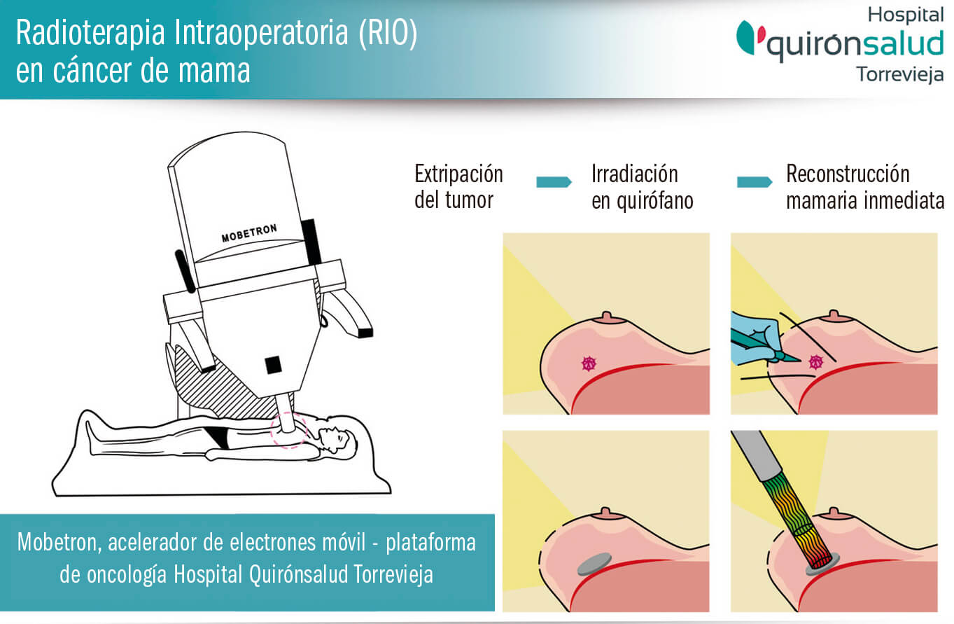 Radioterapia intraoperatoria como tratamiento para el cáncer